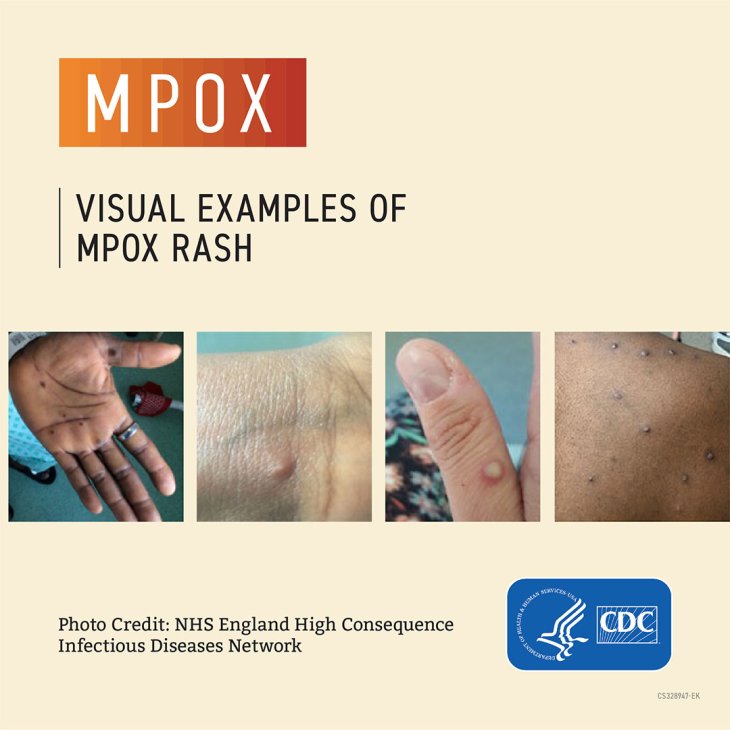 Mpox Cases Persist Among GBMSM in U.S., Despite Decline Since 2022 ...